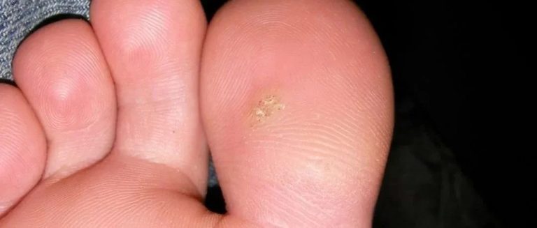 Don’t take these small bumps on your feet lightly, they are plantar ...